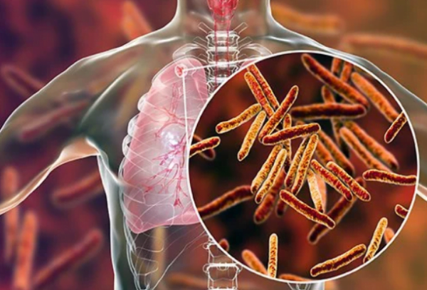 Sutezolid with 3-drug combo appears safe and effective in multidrug ...