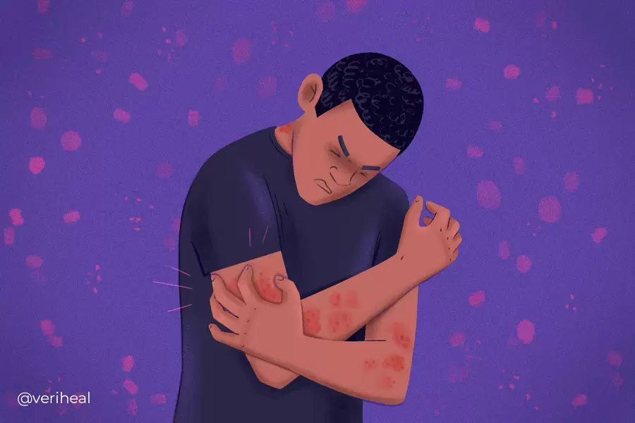 HIV outcomes not affected during first year of biologic therapy for ...